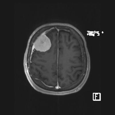 Meningeom - NeuroWiki